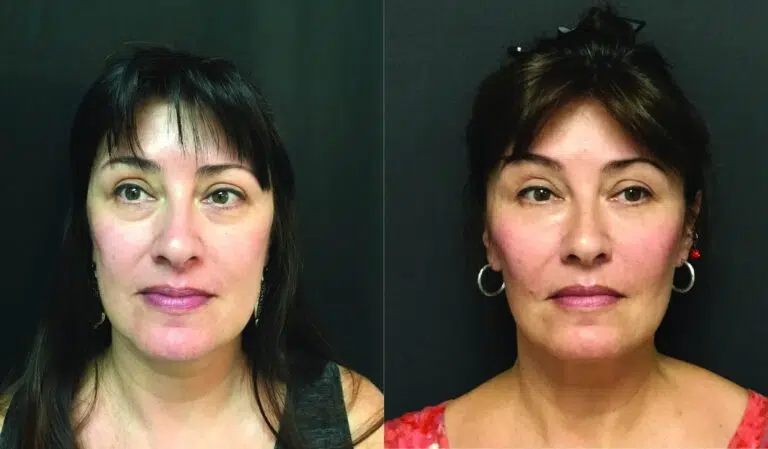 The Ultimate Guide to Bellafill: Long-Lasting Dermal Filler for ...
